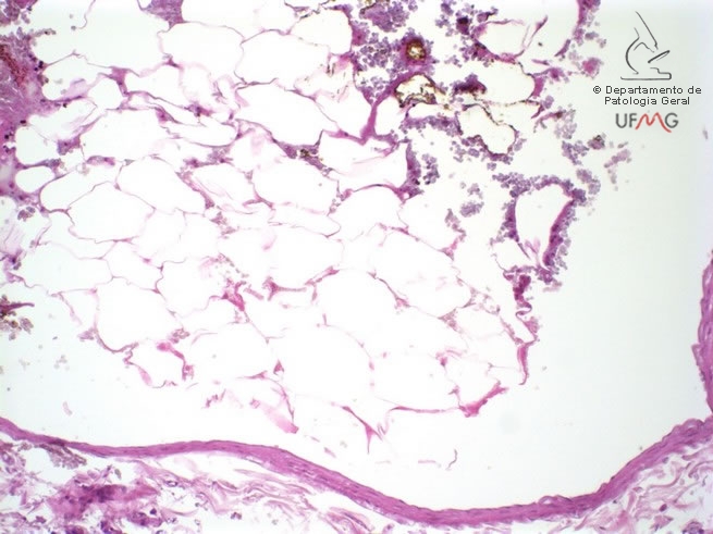 Embolia gordurosa 20x